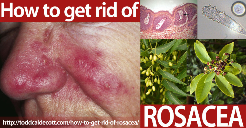 How to get rid of rosacea